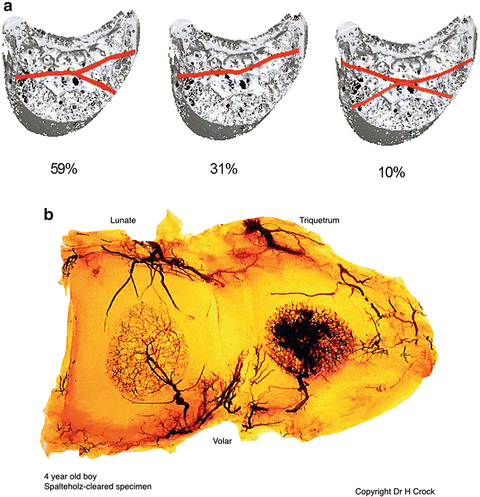 Vascularity of the Lunate | SpringerLink