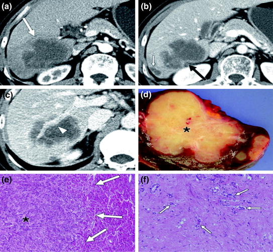 Diagnosis and Management of Intrahepatic and Extrahepatic Cholangiocarcinoma | SpringerLink