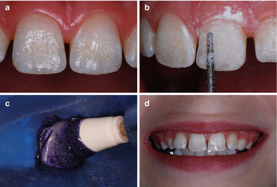 Enamel Microabrasion for Removal of Superficial Coloration and Surface ...