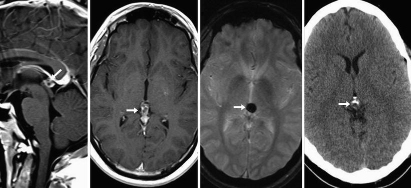 Pineal Gland: Normal Size, Appearance, and Enhancement | SpringerLink