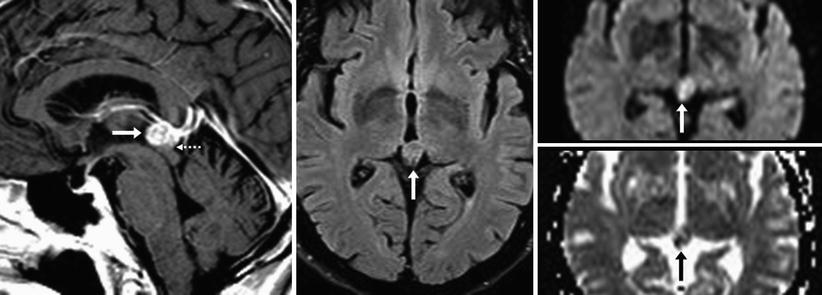 Pineal Gland: Normal Size, Appearance, and Enhancement | SpringerLink