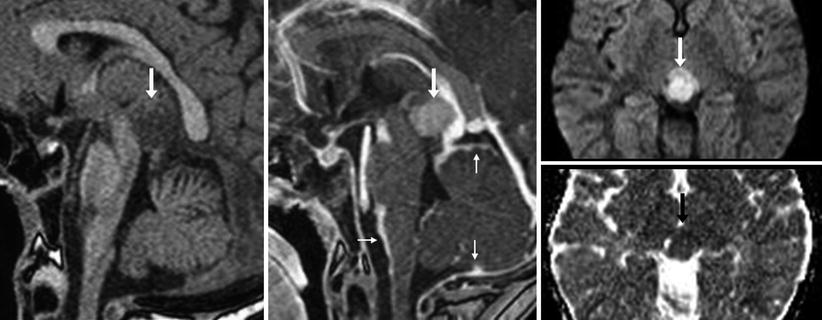 Pineal Gland: Normal Size, Appearance, and Enhancement | SpringerLink