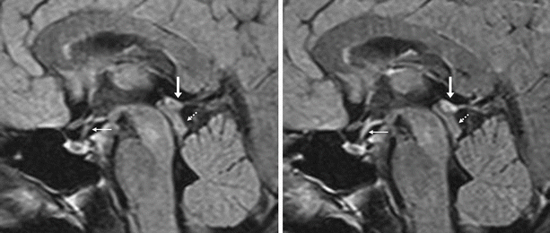 Pineal Gland: Normal Size, Appearance, and Enhancement | SpringerLink