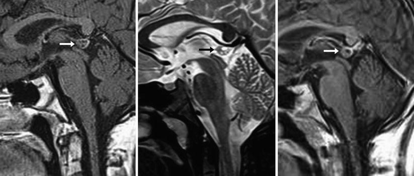 Pineal Gland: Normal Size, Appearance, and Enhancement | SpringerLink