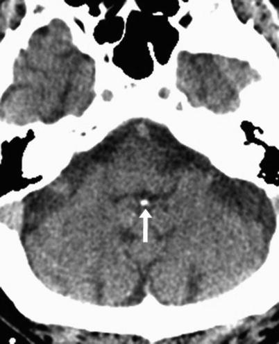 Choroid Plexus: Normal Locations and Appearances | SpringerLink
