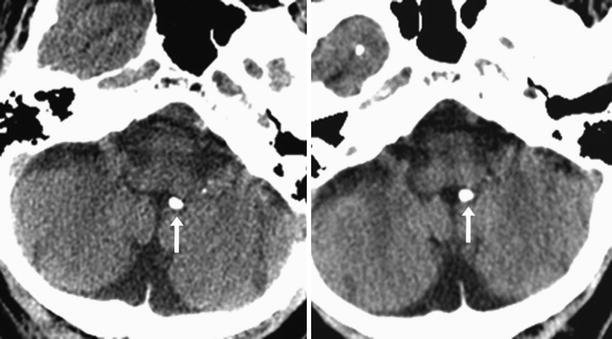 Choroid Plexus: Normal Locations and Appearances | SpringerLink