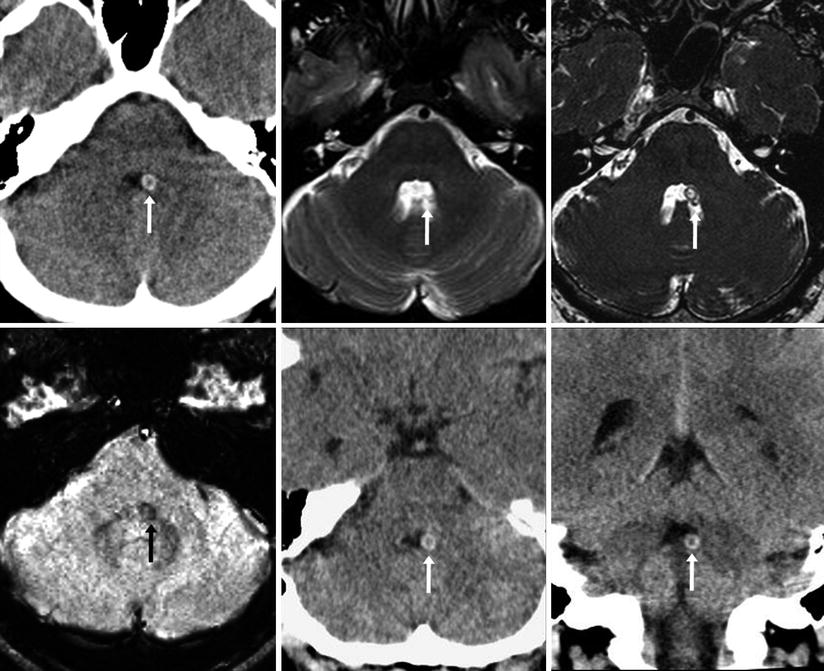 Choroid Plexus: Normal Locations and Appearances | SpringerLink