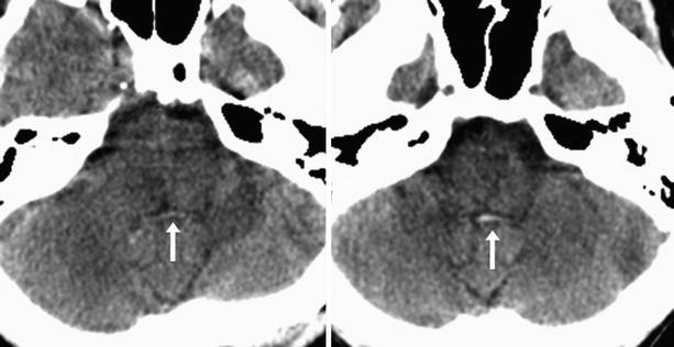 Choroid Plexus: Normal Locations and Appearances | SpringerLink