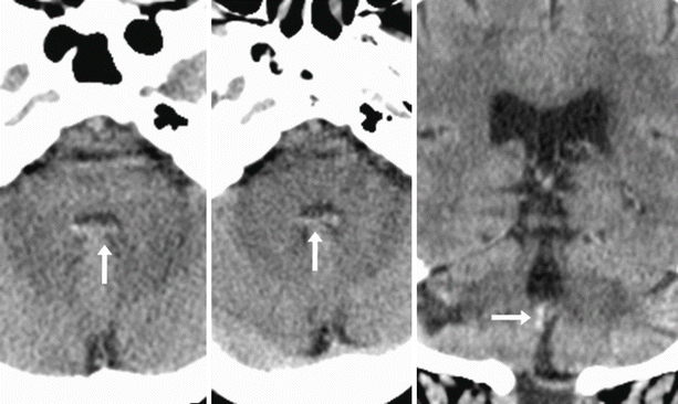 Choroid Plexus: Normal Locations and Appearances | SpringerLink
