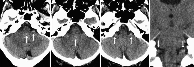 Choroid Plexus: Normal Locations and Appearances | SpringerLink