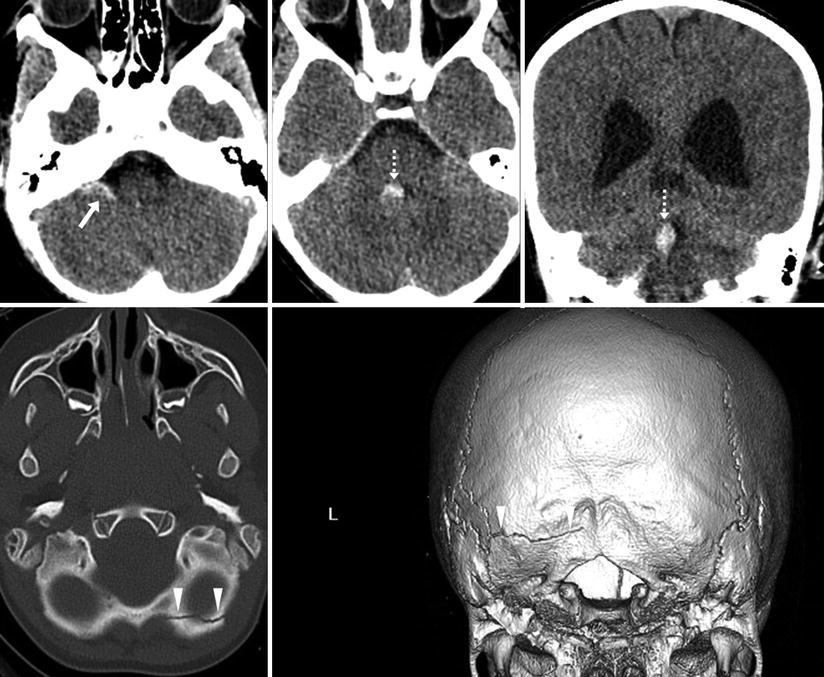 Choroid Plexus: Normal Locations and Appearances | SpringerLink