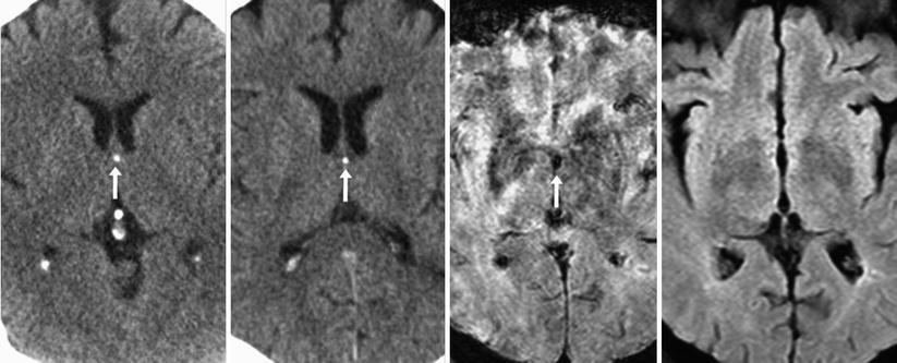 Choroid Plexus: Normal Locations and Appearances | SpringerLink