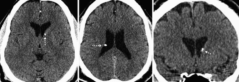 Choroid Plexus: Normal Locations and Appearances | SpringerLink