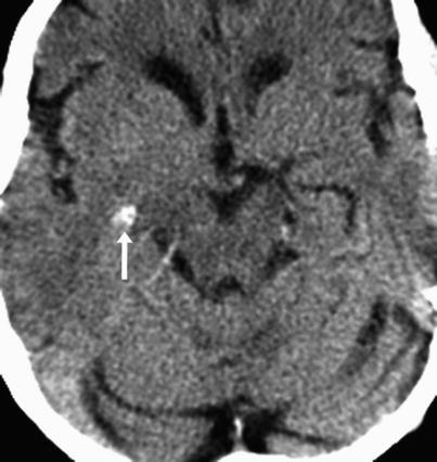 Choroid Plexus: Normal Locations and Appearances | SpringerLink