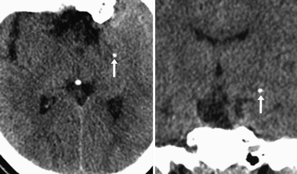 Choroid Plexus: Normal Locations and Appearances | SpringerLink