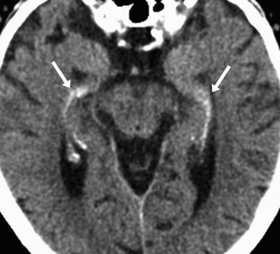 Choroid Plexus: Normal Locations and Appearances | SpringerLink