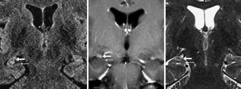 Choroid Plexus: Normal Locations and Appearances | SpringerLink