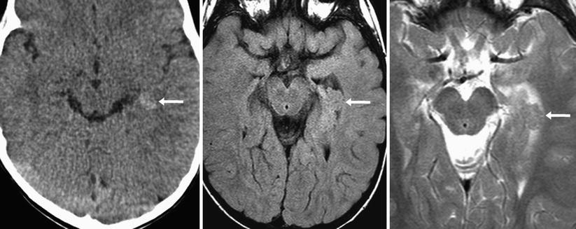 Choroid Plexus: Normal Locations and Appearances | SpringerLink