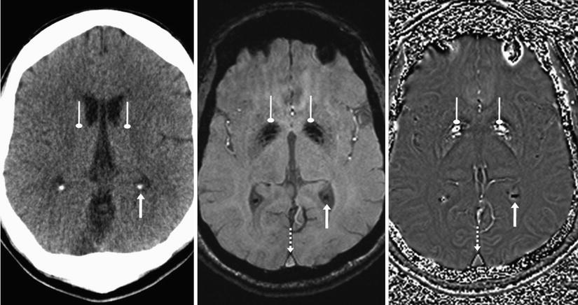 Choroid Plexus: Normal Locations and Appearances | SpringerLink