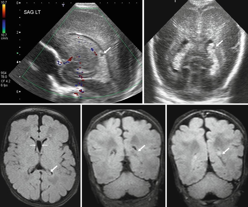 Choroid Plexus: Normal Locations and Appearances | SpringerLink