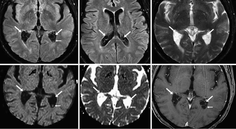 Choroid Plexus: Normal Locations and Appearances | SpringerLink