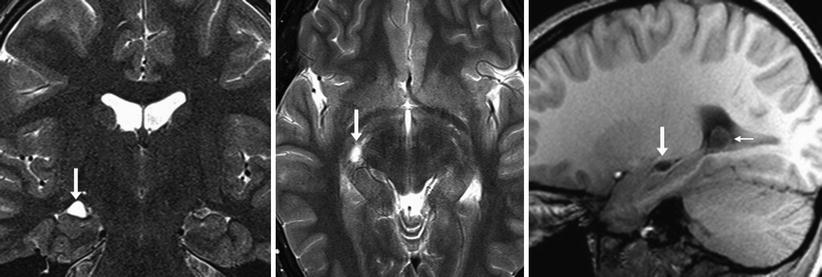 Choroid Plexus: Normal Locations and Appearances | SpringerLink