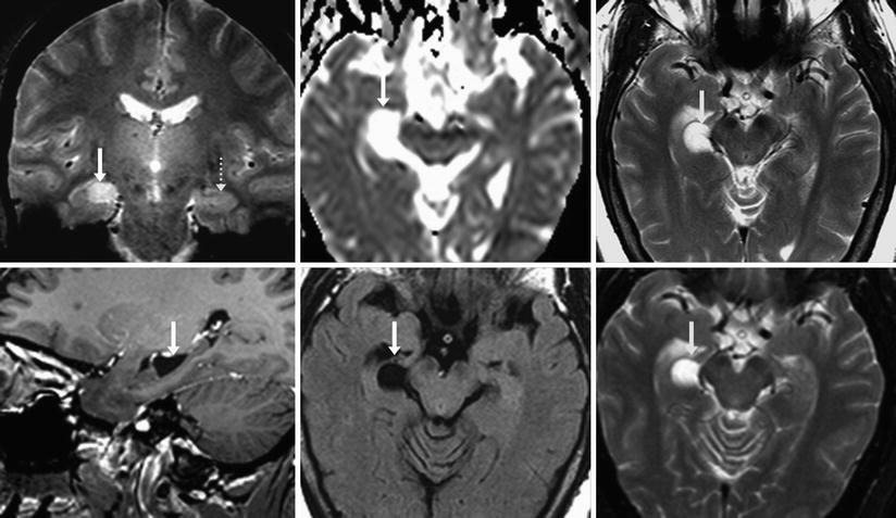 Choroid Plexus: Normal Locations and Appearances | SpringerLink