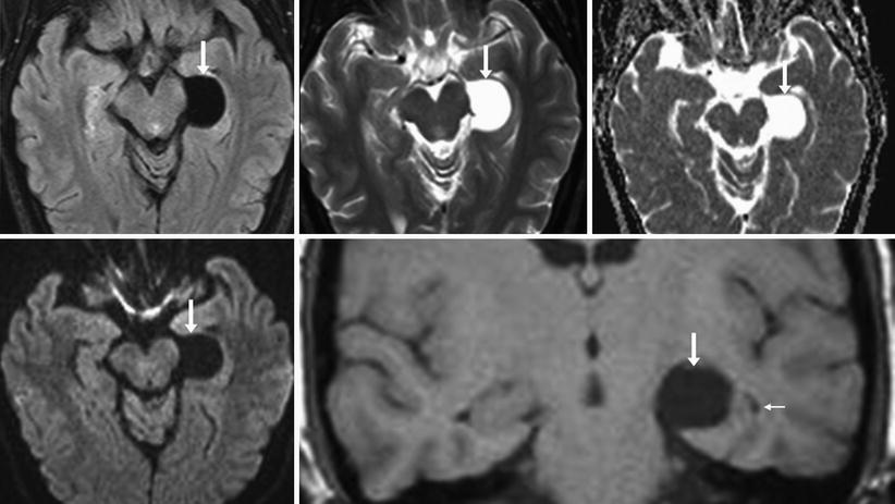 Choroid Plexus: Normal Locations and Appearances | SpringerLink