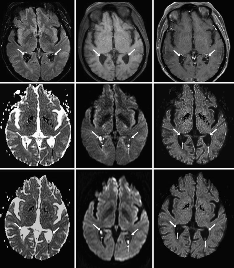 Choroid Plexus: Normal Locations and Appearances | SpringerLink