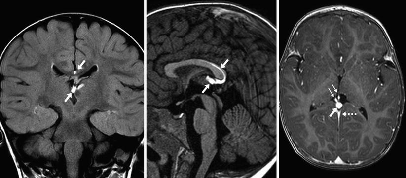 Choroid Plexus: Normal Locations and Appearances | SpringerLink
