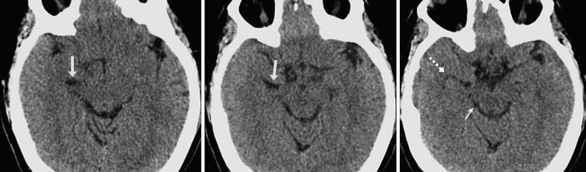 Choroid Plexus: Normal Locations and Appearances | SpringerLink