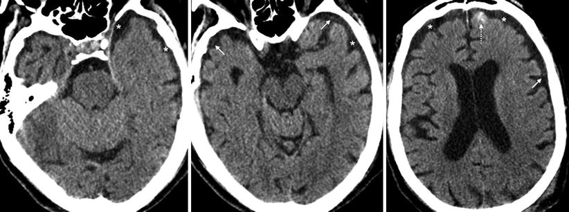 Cerebral or Cerebellar Volume Loss Simulating Subdural Hematomas ...