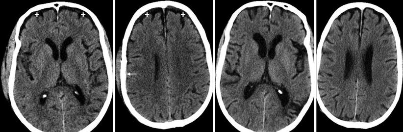 Cerebral or Cerebellar Volume Loss Simulating Subdural Hematomas ...