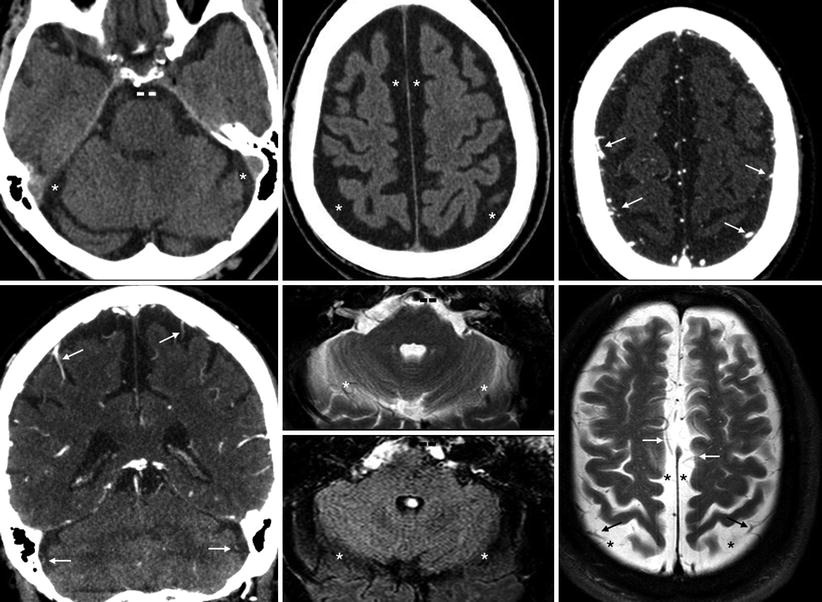 Cerebral or Cerebellar Volume Loss Simulating Subdural Hematomas ...