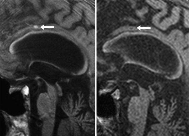 Dural Calcifications: Normal Locations and Appearances | SpringerLink