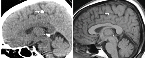 Dural Calcifications: Normal Locations and Appearances | SpringerLink