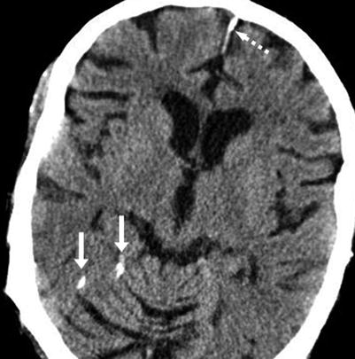 Dural Calcifications: Normal Locations and Appearances | SpringerLink