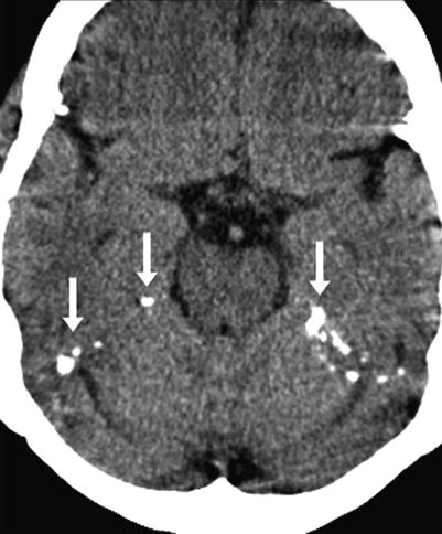 Dural Calcifications: Normal Locations and Appearances | SpringerLink