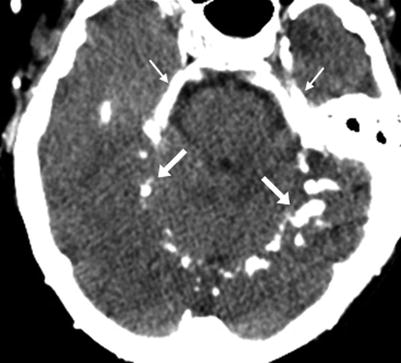 Dural Calcifications: Normal Locations and Appearances | SpringerLink