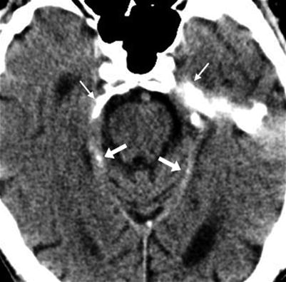 Dural Calcifications: Normal Locations and Appearances | SpringerLink