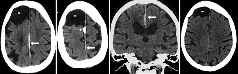 Dural Calcifications: Normal Locations and Appearances | SpringerLink