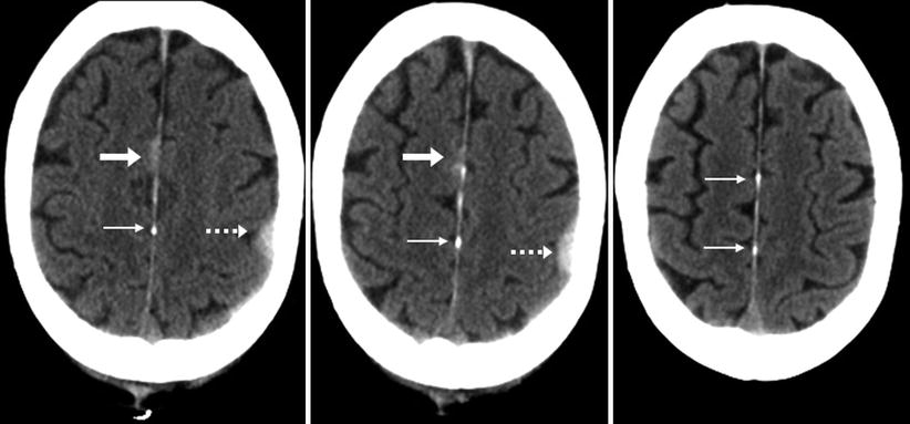 Dural Calcifications: Normal Locations and Appearances | SpringerLink