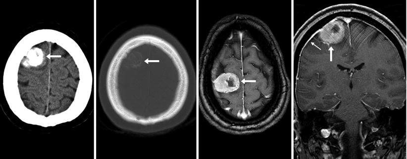 Dural Calcifications: Normal Locations and Appearances | SpringerLink