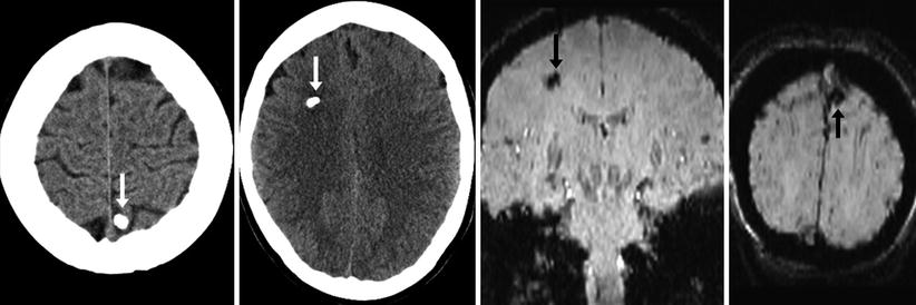Dural Calcifications: Normal Locations and Appearances | SpringerLink