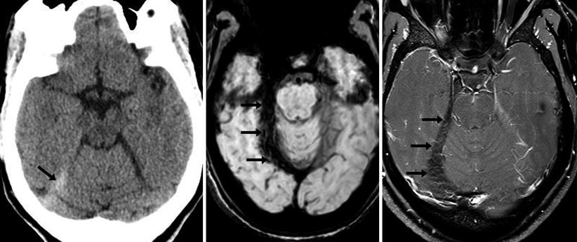 Dural Calcifications: Normal Locations and Appearances | SpringerLink