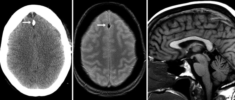 Dural Calcifications: Normal Locations and Appearances | SpringerLink