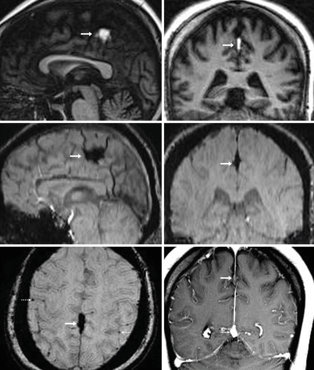 Dural Calcifications: Normal Locations and Appearances | SpringerLink