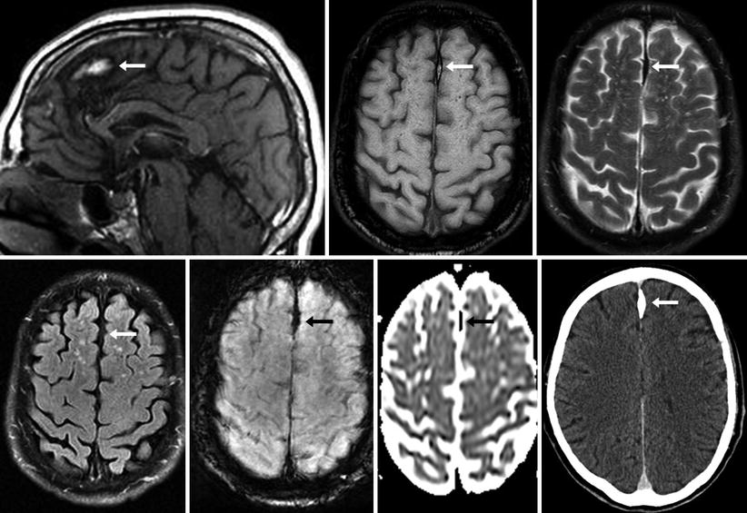 Dural Calcifications: Normal Locations and Appearances | SpringerLink
