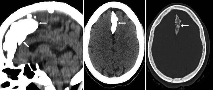 Dural Calcifications: Normal Locations and Appearances | SpringerLink