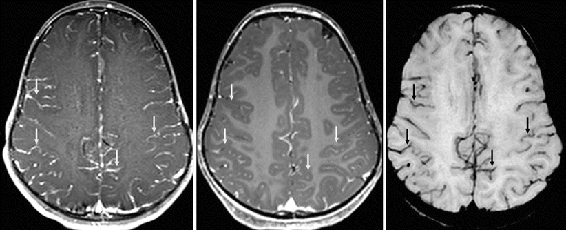 Pseudo-leptomeningeal Contrast Enhancement | SpringerLink